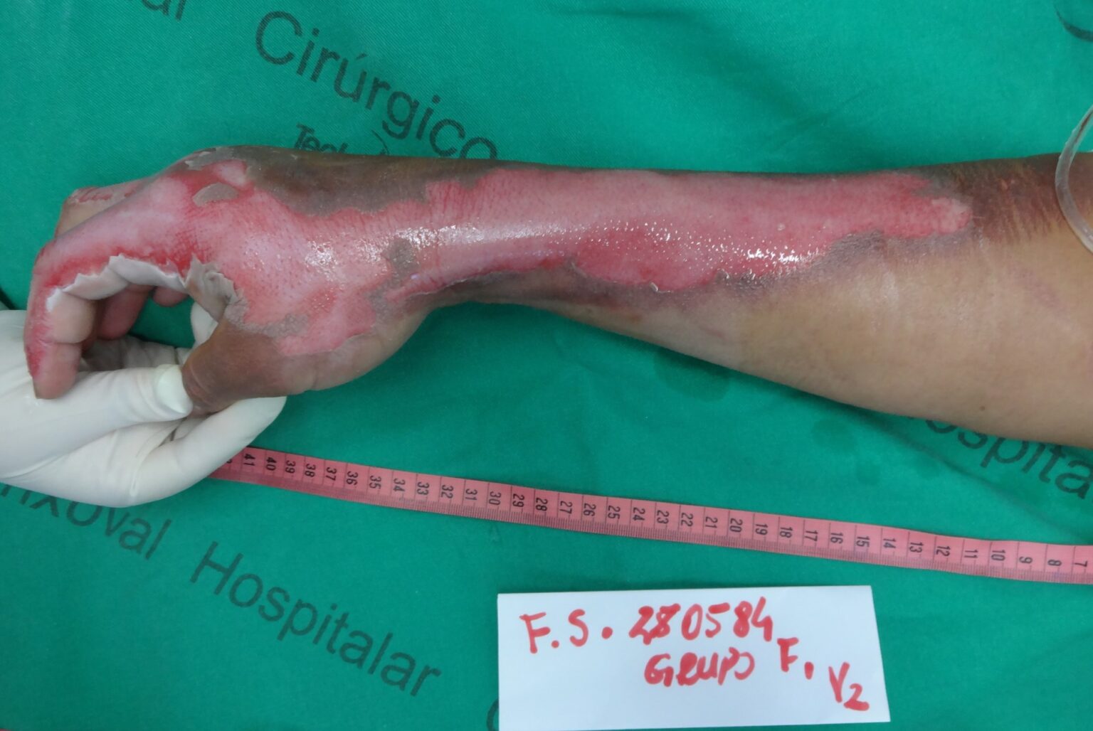 Fish skin speeds up healing in burns patients - Super Innovators